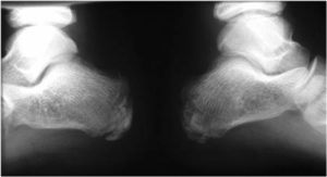 Apophysitis calcanei (Sever´s Krankheit) | Der Fußspezialist