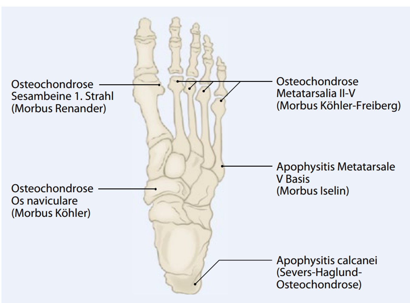 Morbus Renander - Aseptische Nekrose des Sesambeins | Der Fußspezialist