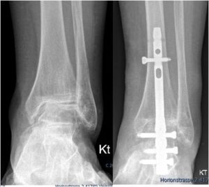 OSG Arthrose: Arthrose des oberen Sprunggelenkes | Der Fußspezialist