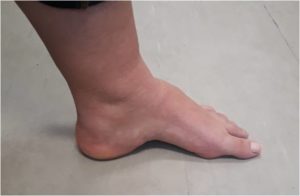 Hohlfuß (Pes cavo-varus) | Der Fußspezialist