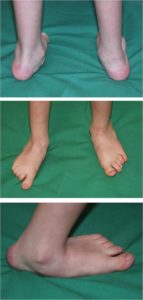 Talus verticalis | Der Fußspezialist