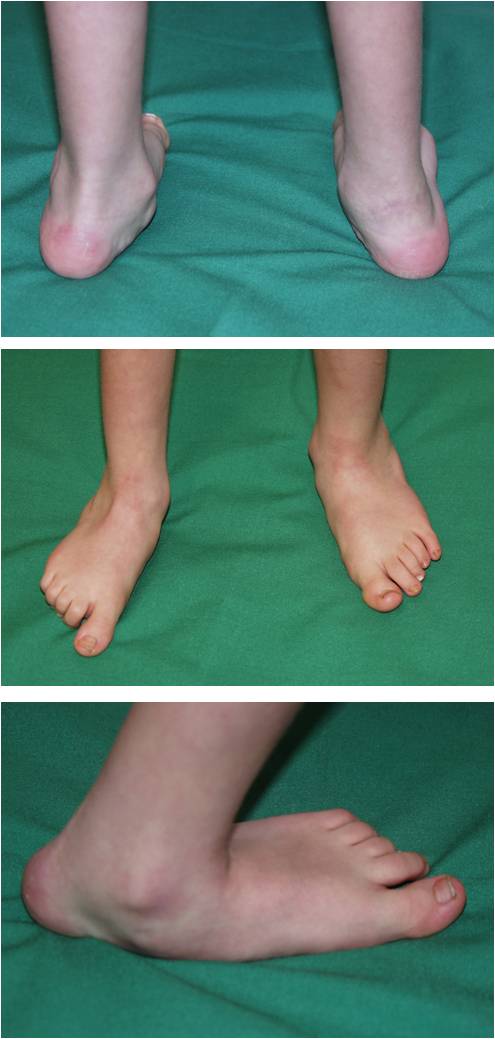 Talus verticalis | Der Fußspezialist